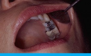 bite-adjustment-2 - Your Dental Specialist