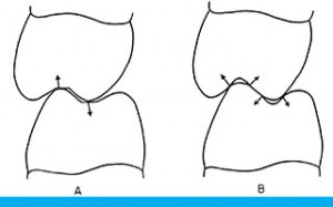 Bite Adjustment - Occlusal Adjustment - Spot Grinding