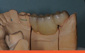 Dental Bridges For Missing Teeth - Fixed Prosthesis