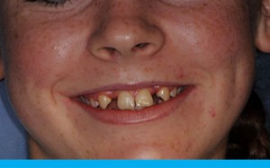 Composite Resin Overlays - Quick - Less Expensive