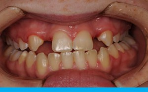 Composite Resin Overlays - Quick - Less Expensive