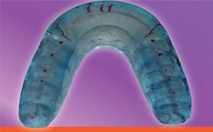 Occlusal Splint Therapy - Fully Protective Occlusal Splints