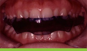 Occlusal Splint Therapy - Fully Protective Occlusal Splints