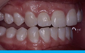 partial-bite-reconstruction-1d - Your Dental Specialist