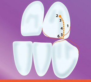 Partial Bite Reconstruction - Left Right and Forward Bites